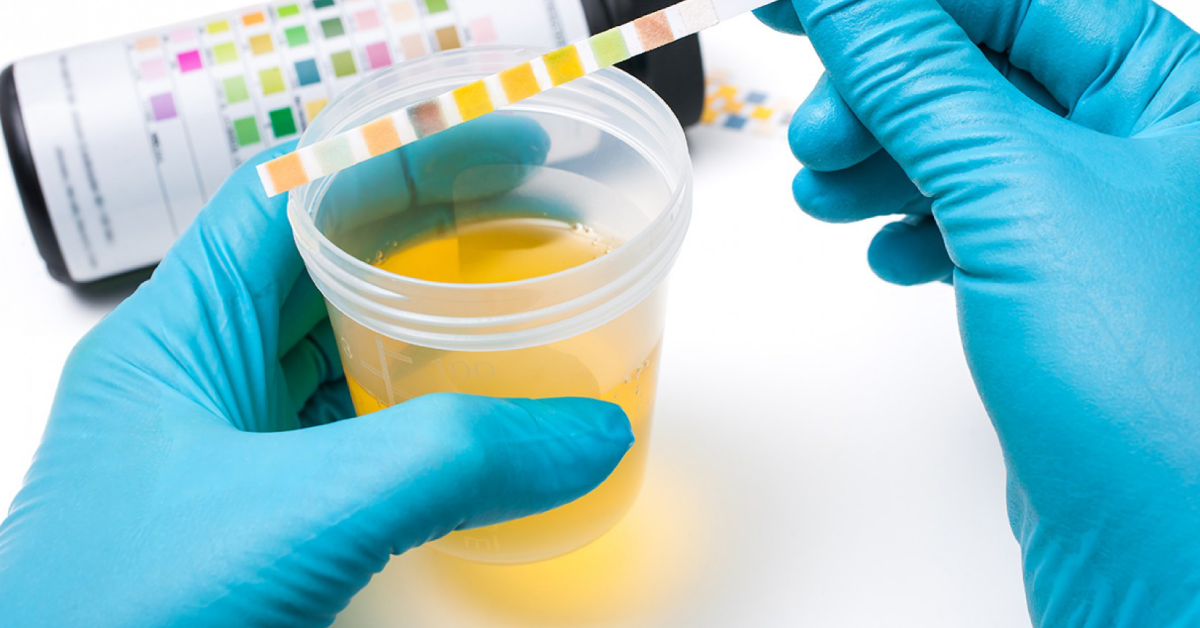 O que a cor da urina diz sobre sua saúde? – Dr. Felipe Ladeira